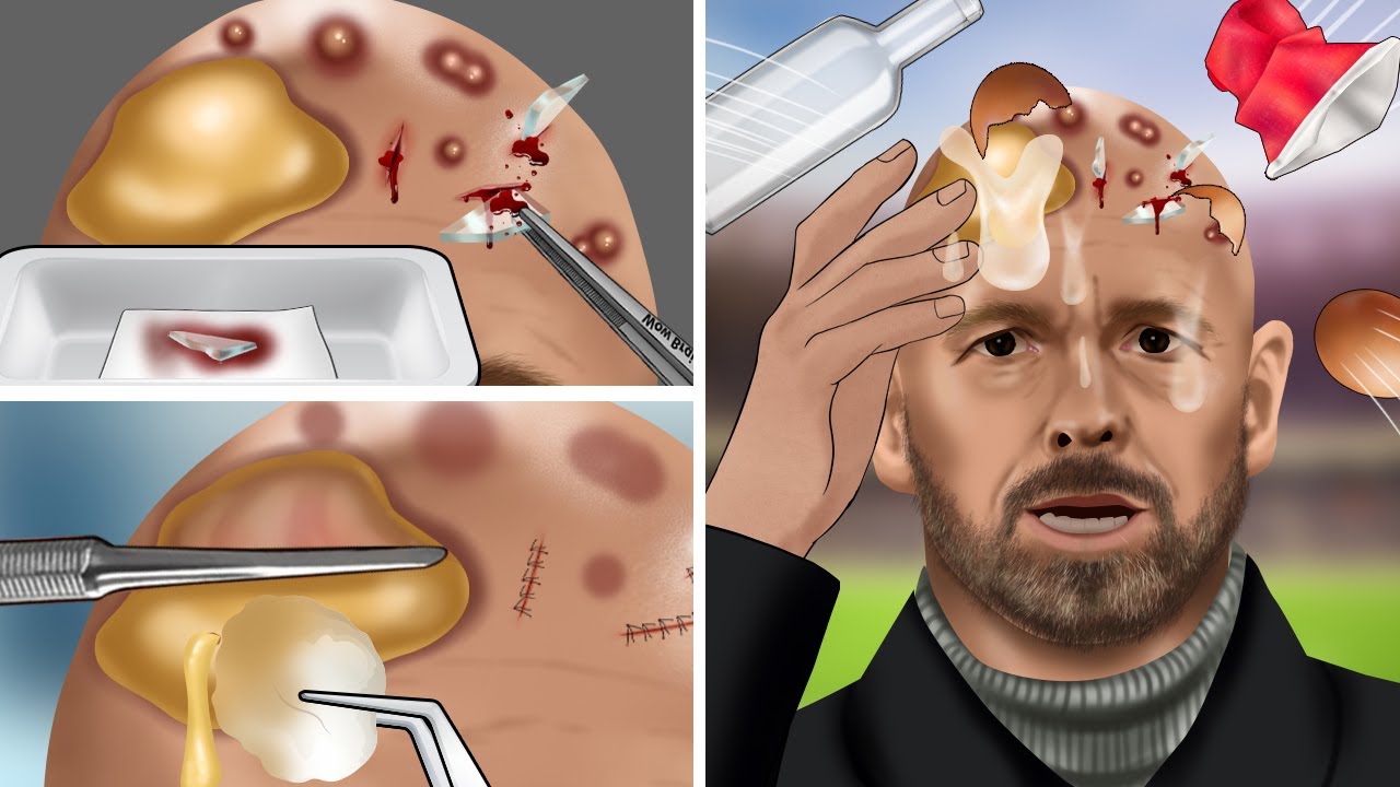 [ASMR] Help Erik Ten Hag treat the wound on the top of his bald head ...