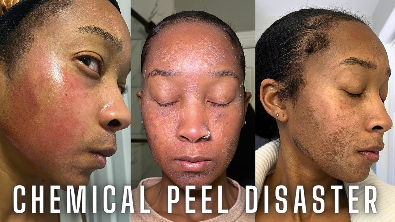 Chemical Peel Nightmare! Full Peeling Process. Before, During, and ...