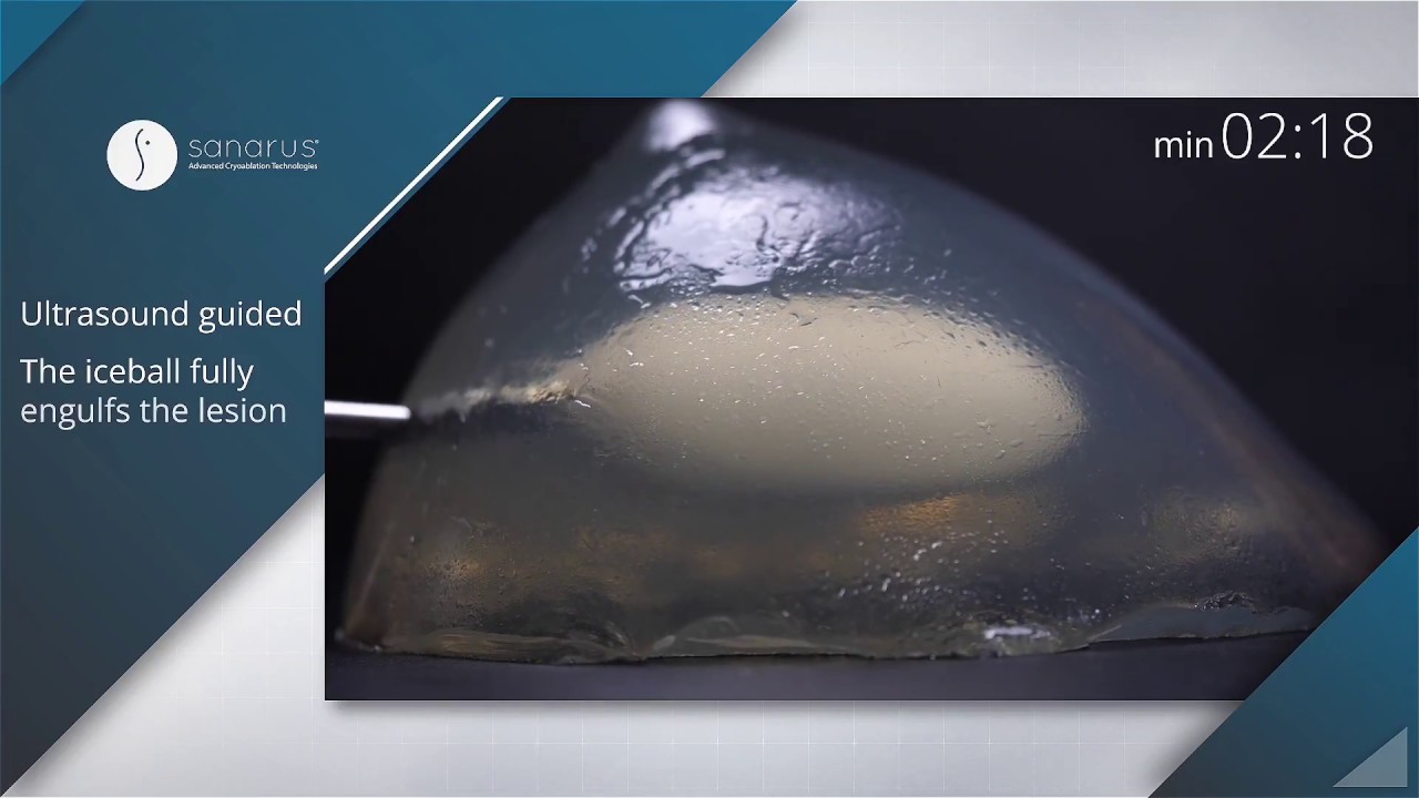 Visica 2 Treatment System Video - YouTube