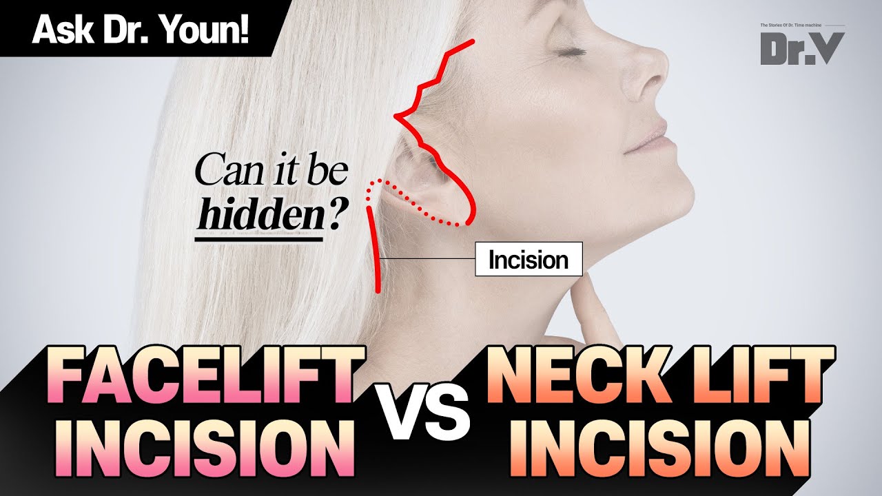 Facelift FAQ) Where is the incision for the neck lift? - YouTube