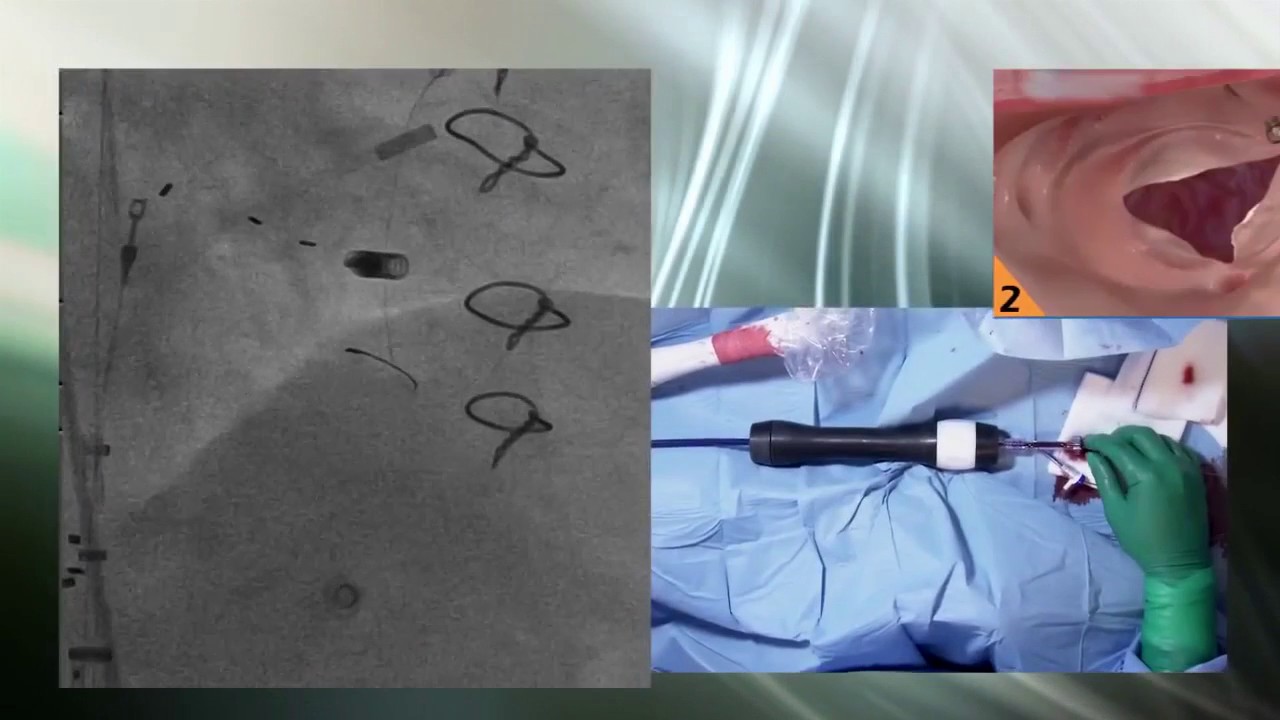 TriCinch System Milan 2015 - YouTube