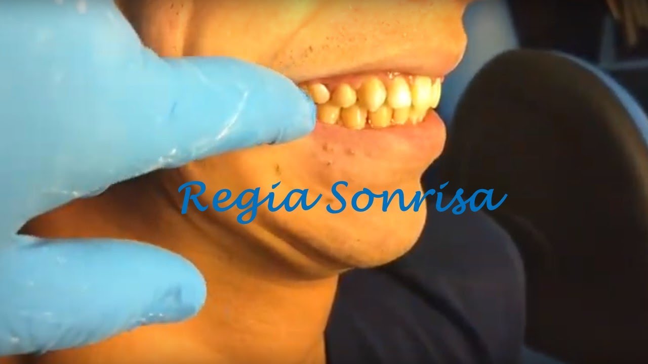 Ortodoncia Real, final de tratamiento de ortodoncia con extracciones de ...