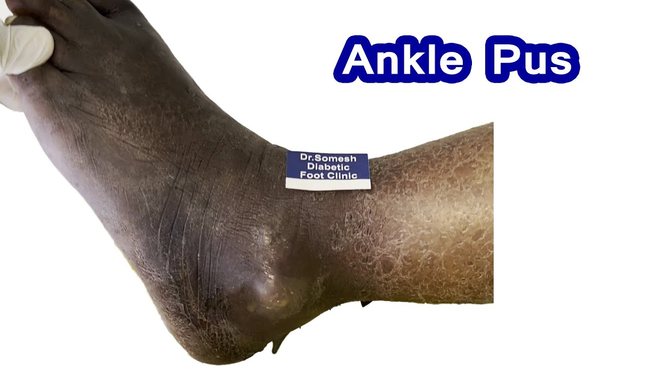 #ankle #infection Healing Stages - YouTube