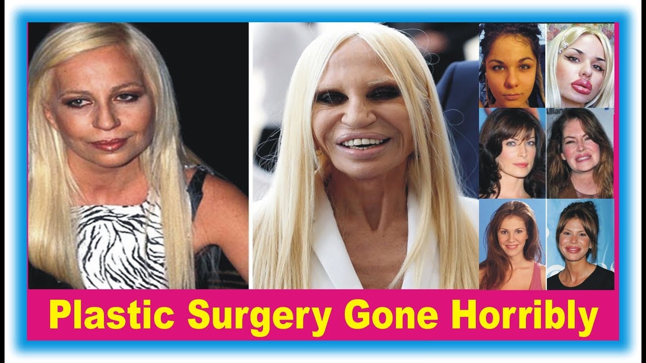 Plastic Surgery Gone Horribly Wrong Top 9 Worst Plastic Surgery - YouTube