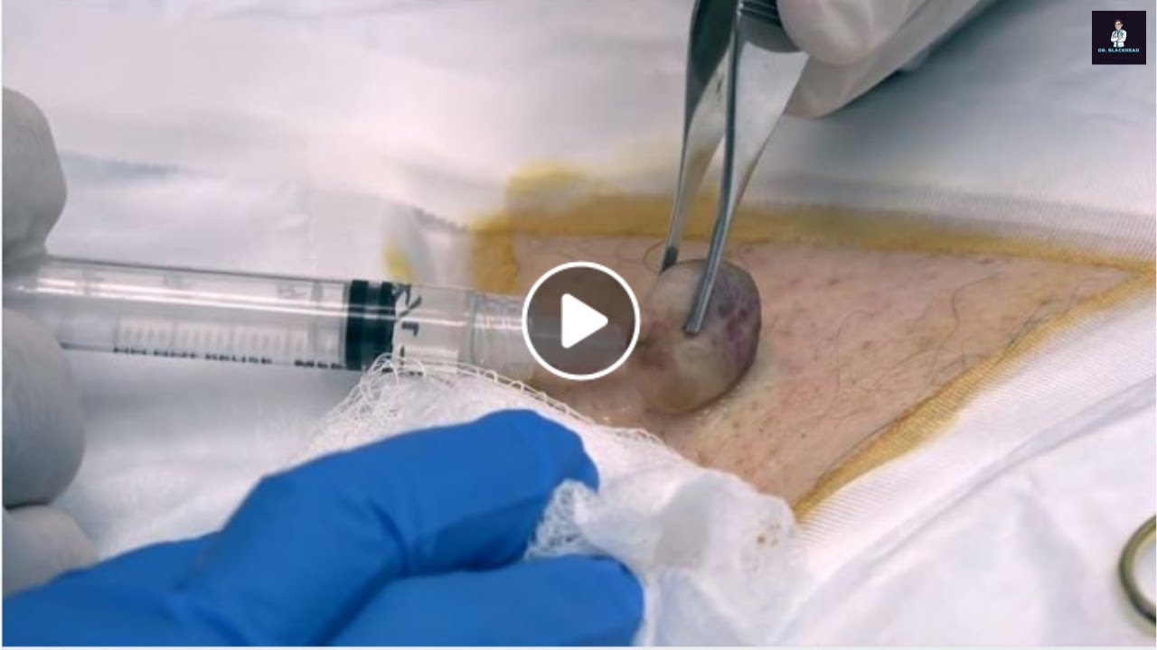 Inflamed Neck Cyst Explosion ! - YouTube