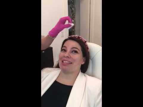 BOTOX Behandlung der Stirn mit Beatriz Strobel - YouTube