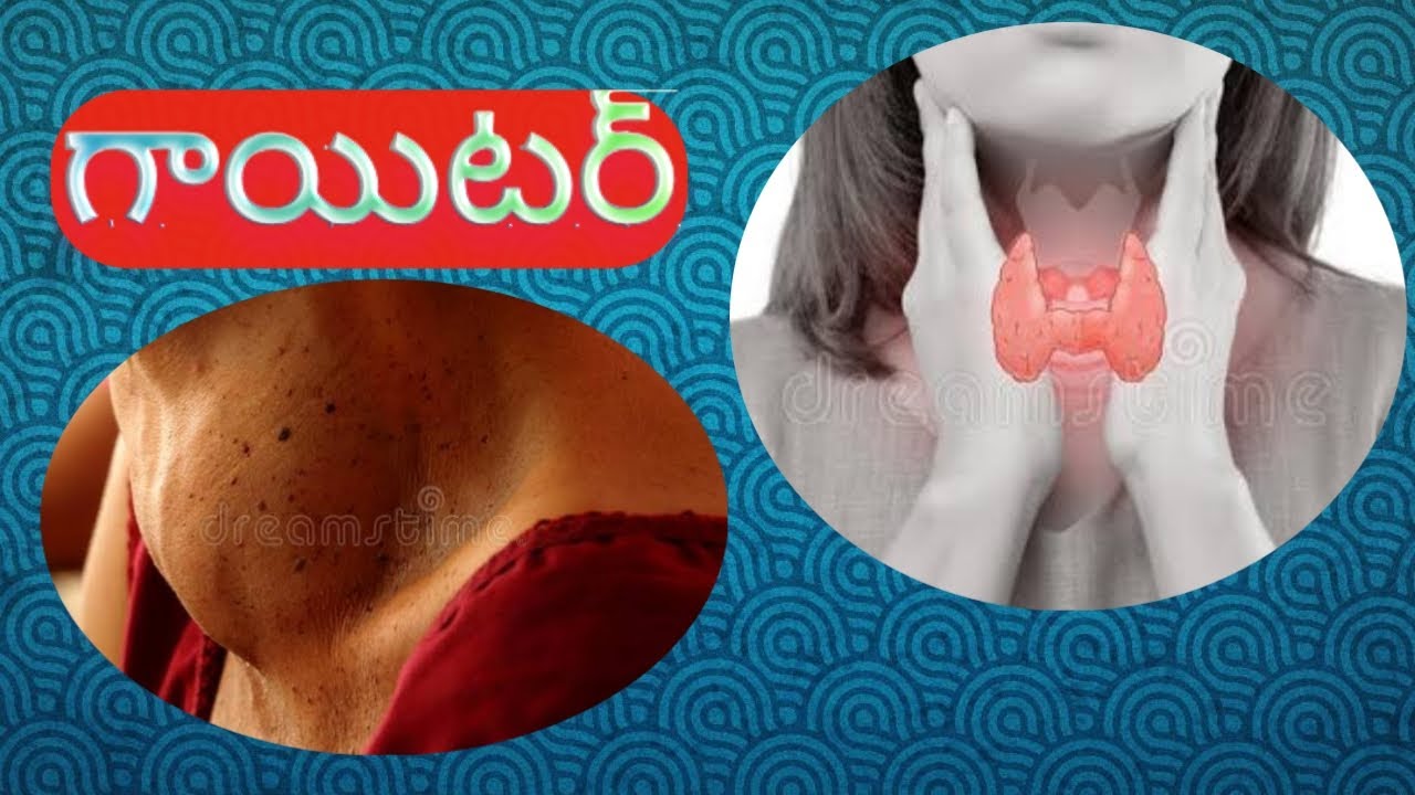 (V248) goitre || hypothyroidism || galaganda - YouTube
