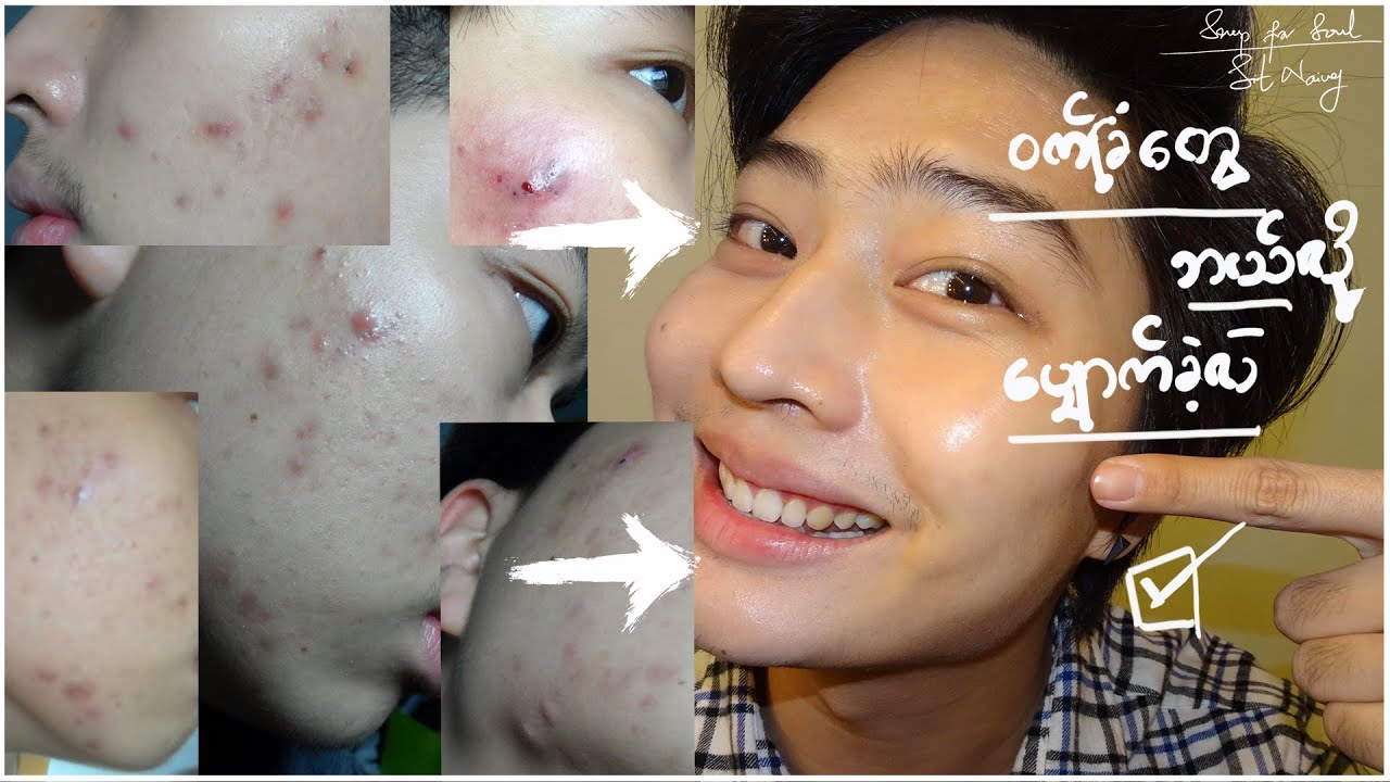 Acne Journey Youtube