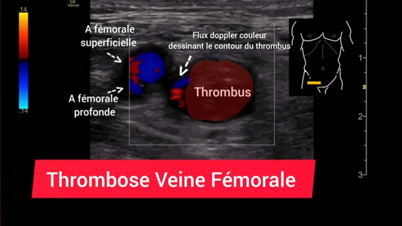 Thrombose Veineuse Fémorale Phlébite Échographie Doppler - YouTube