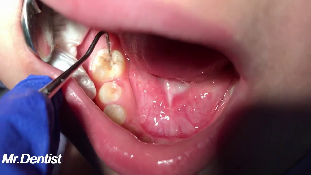Tooth Filing - Child at the dentist !! - YouTube
