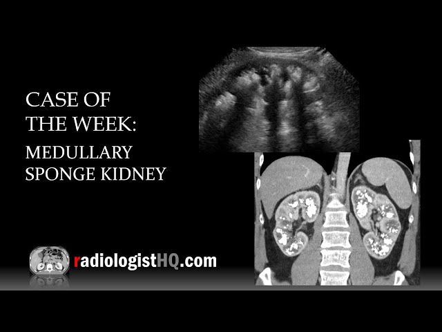 Medullary Sponge Kidney Medullary Sponge Kidney, Ct Scan By Science