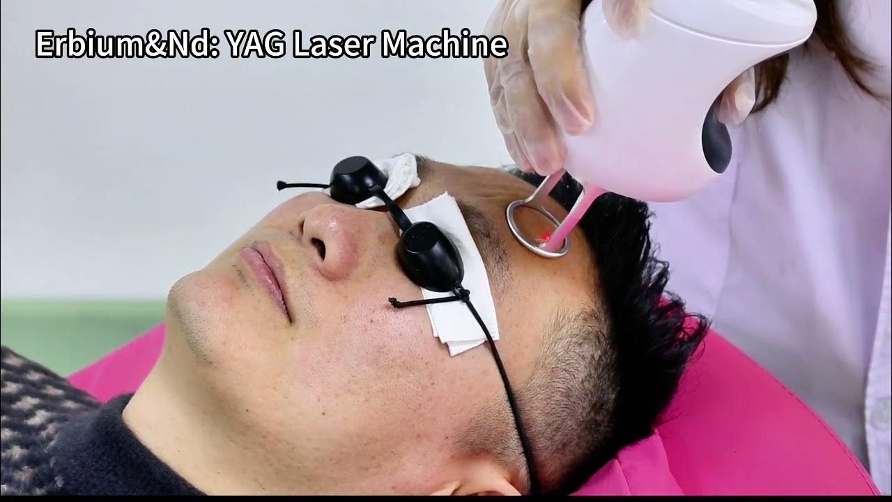 Erbium ND YAG laser machine - YouTube