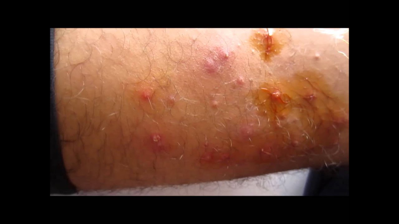 Popping Pustules - YouTube