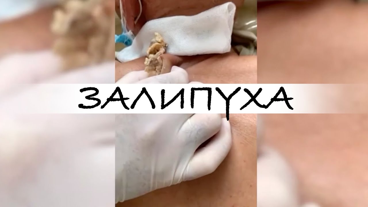 ПРЫЩИ. АТЕРОМА СПИНЫ. ДАВИМ ПРЫЩИ НА СПИНЕ. ПРЫЩИ ВЫДАВЛИВАНИЕ. ПРЫЩИ ...