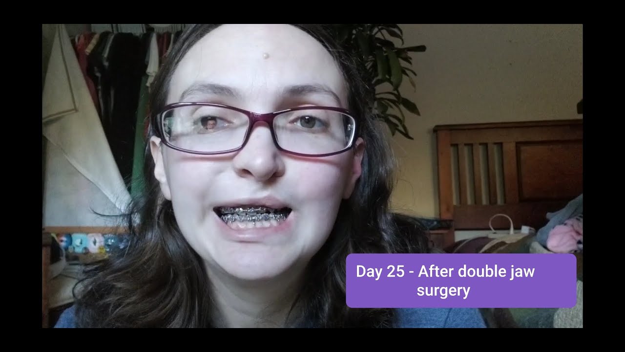 Double Jaw Surgery Day 25 - Corrective cleft lip and palate surgery ...