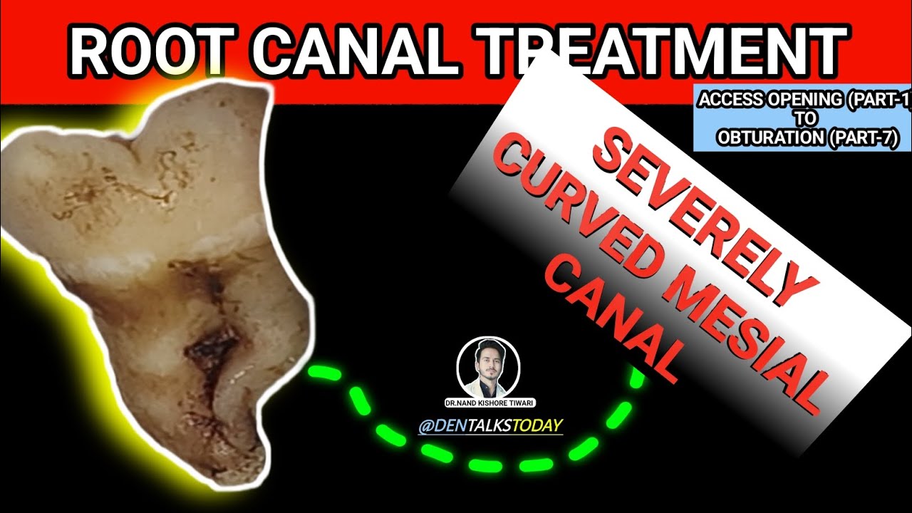 PART-1--How To Manage Curved Root Canal || Root Canal Procedure ...