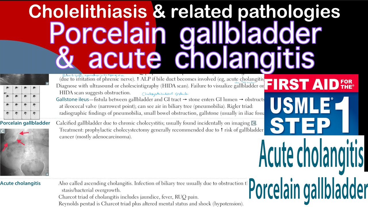 Porcelain gallbladder & Acute cholangitis in Hindi/Urdu by first aid ...