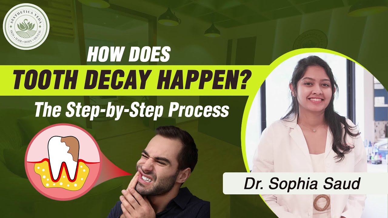 Tooth Decay Breakdown: The 4 Stages of Cavity Formation! - Dr. Sophia ...