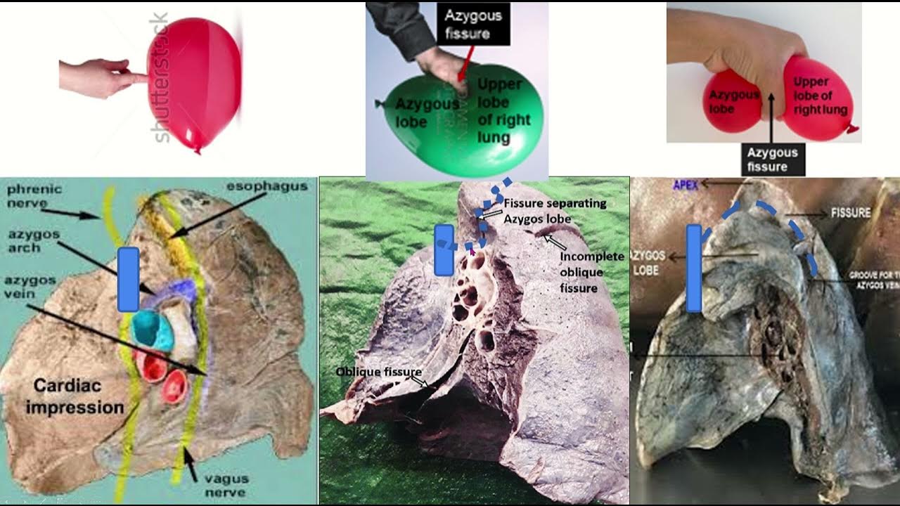 Azygos Vein & Fissure on Radiology: X-ray, CT, & MRI - YouTube
