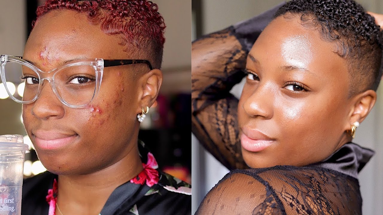 How I Cleared My Cystic Acne And Scars Acne Skincare Routine Youtube