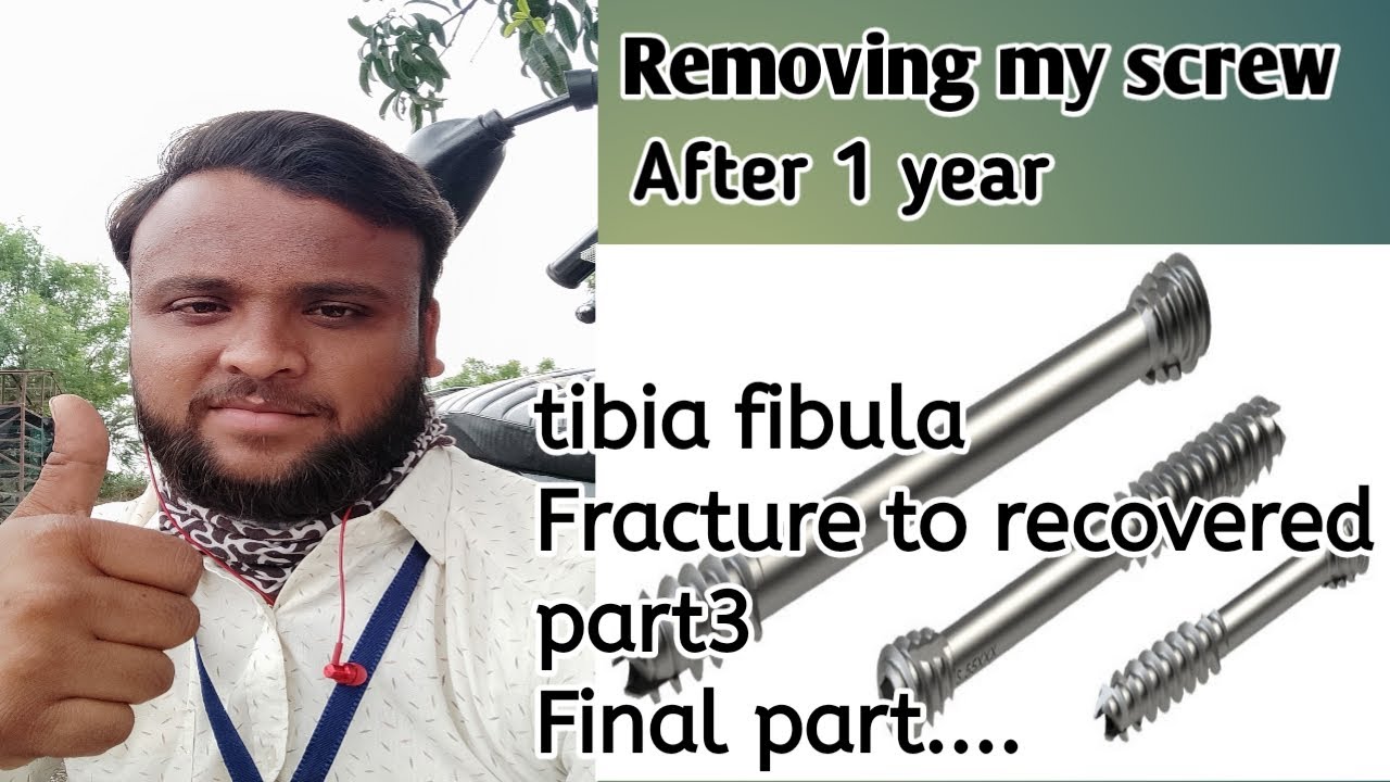 Fracture to recovery Final part my experience tibia fibula all answers ...