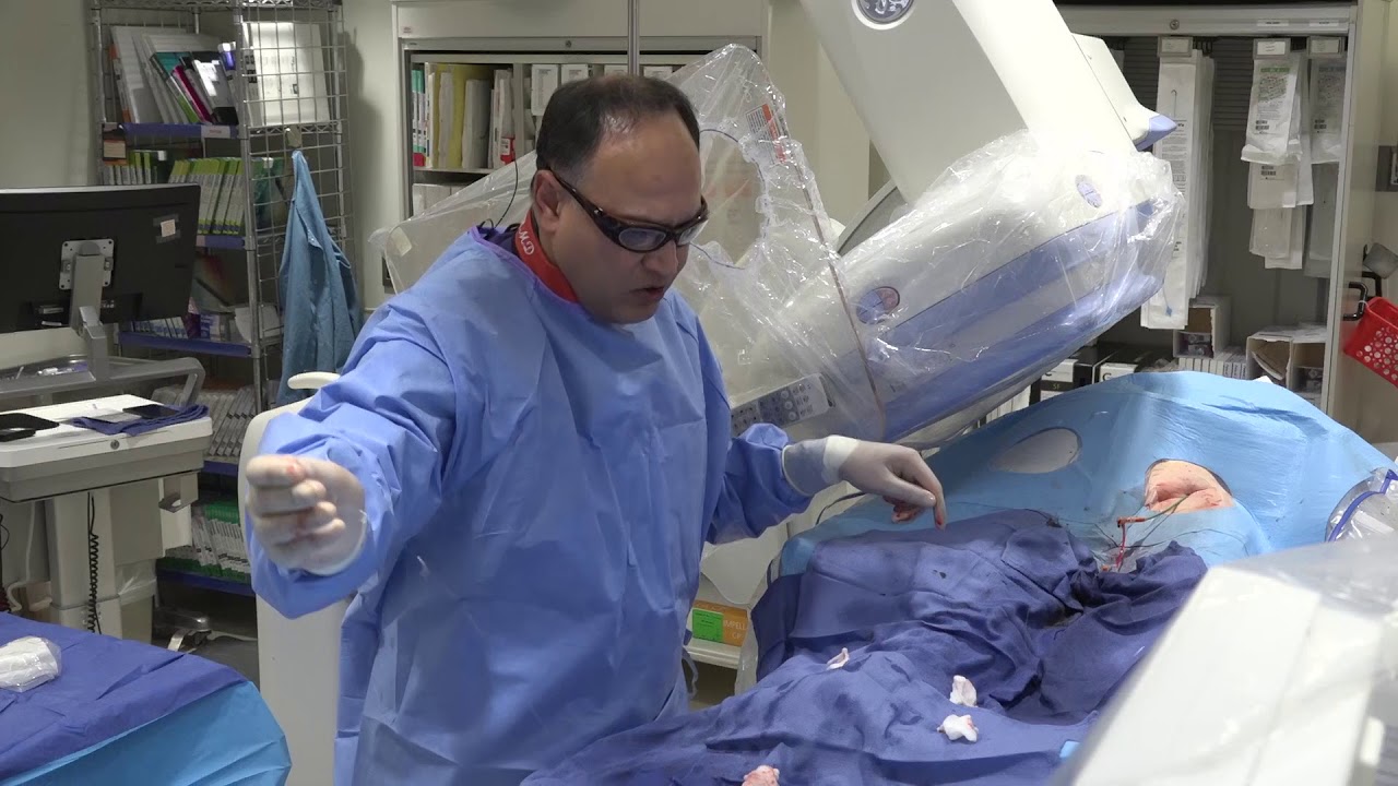 Complex Calcified Occlusion involving distal CFA, SFA and PFA origins ...