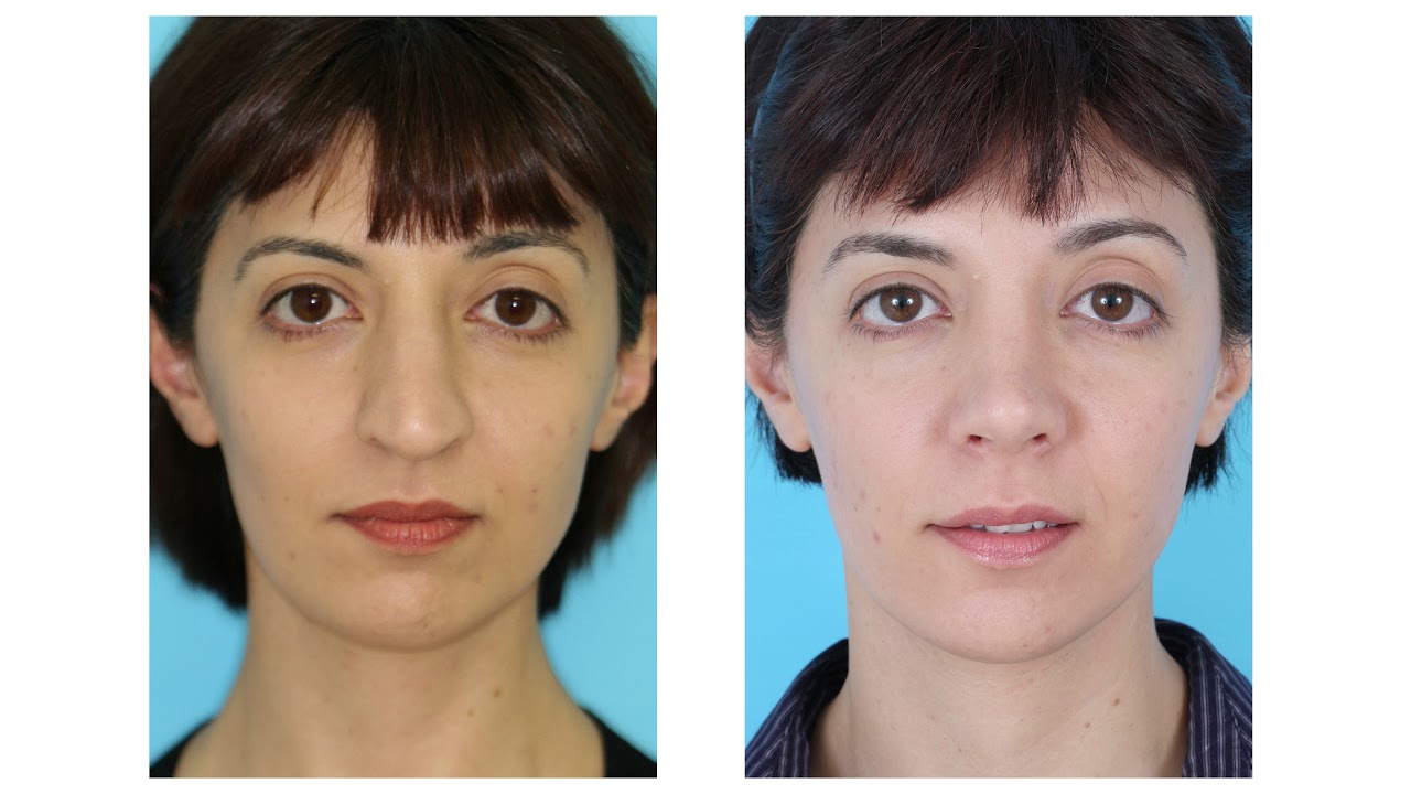 Ethnic Rhinoplasty: Middle Eastern Rhinoplasty - YouTube