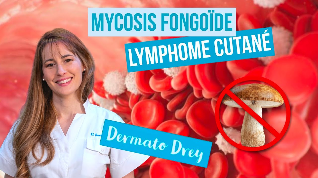 Mycosis fongoïde : un lymphome dans la peau, qu'est ce que c'est ? Les ...