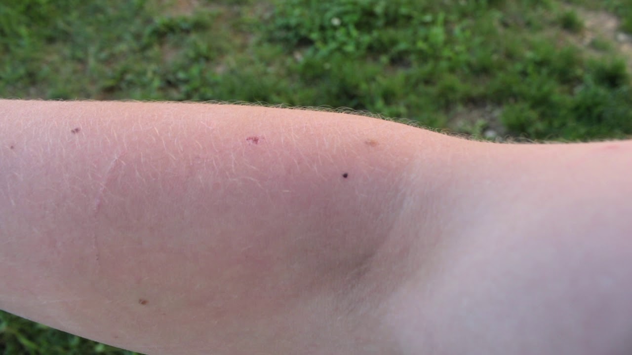 Enlever les tiques - Méthode simple et sans matériel - YouTube