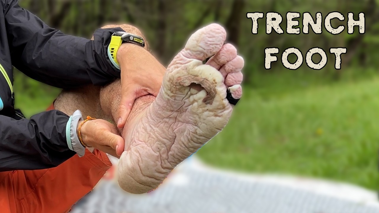 How I got TRENCH FOOT and what happened next - YouTube