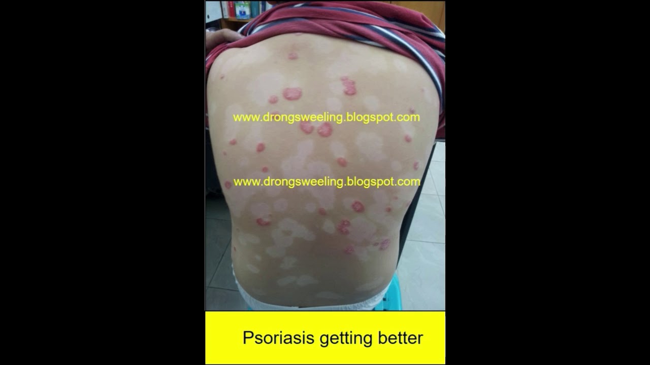 TCM Treatment for Psoriasis in Singapore at Eastern Healing TCM Clinic ...