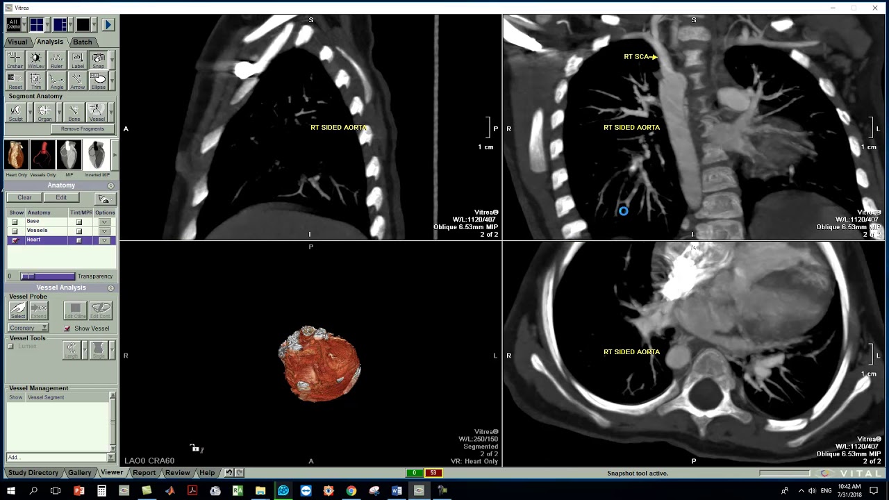 TOF POST PROCESSING UPON VITREA 6 - YouTube