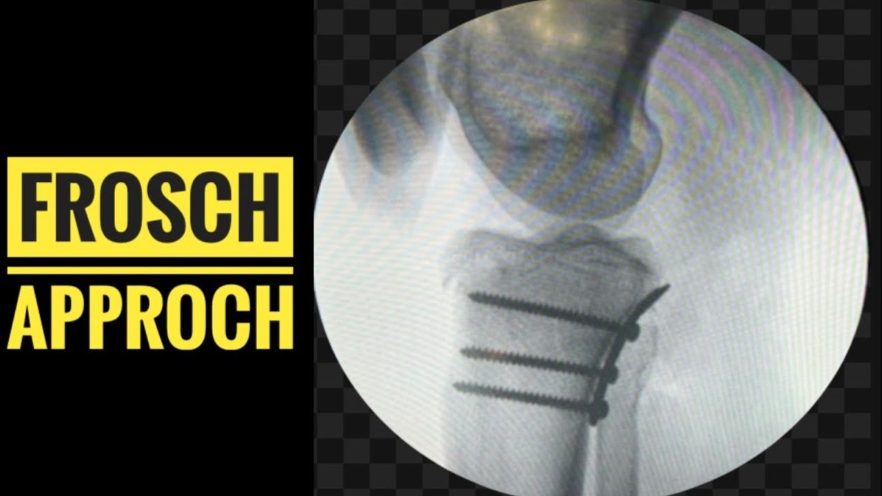 Frosch Approach and Plating of Posterolateral Tibial Plateau - YouTube