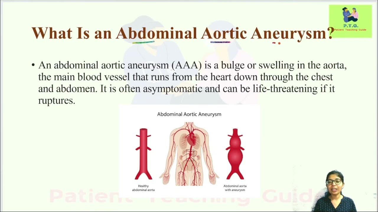 AAA Abdominal Aortic Aneurysm Causes, Symptoms, Diagnosis, Prevention and Treatment - YouTube