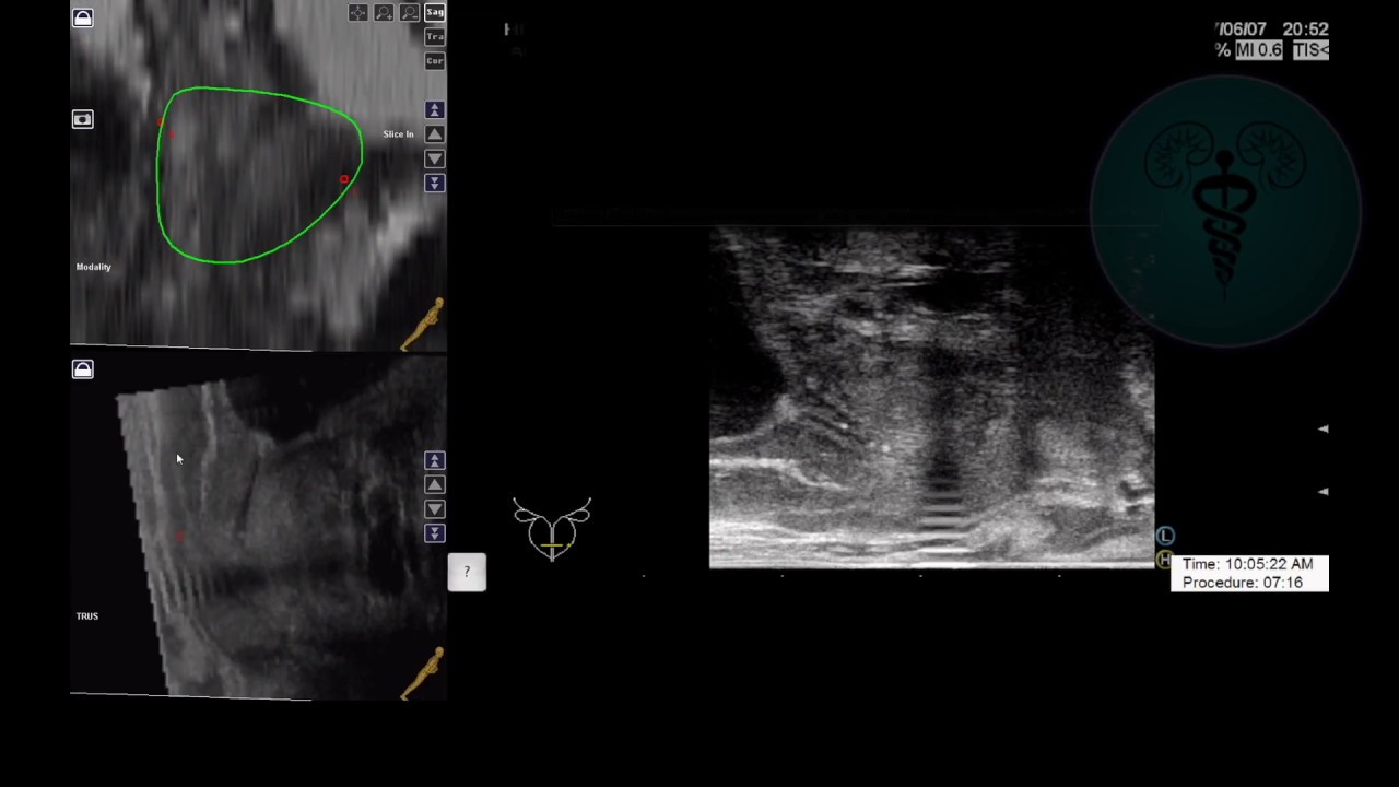 Transperineal MRI/US Fusion targeted prostate biopsy by Dr Elmes - YouTube