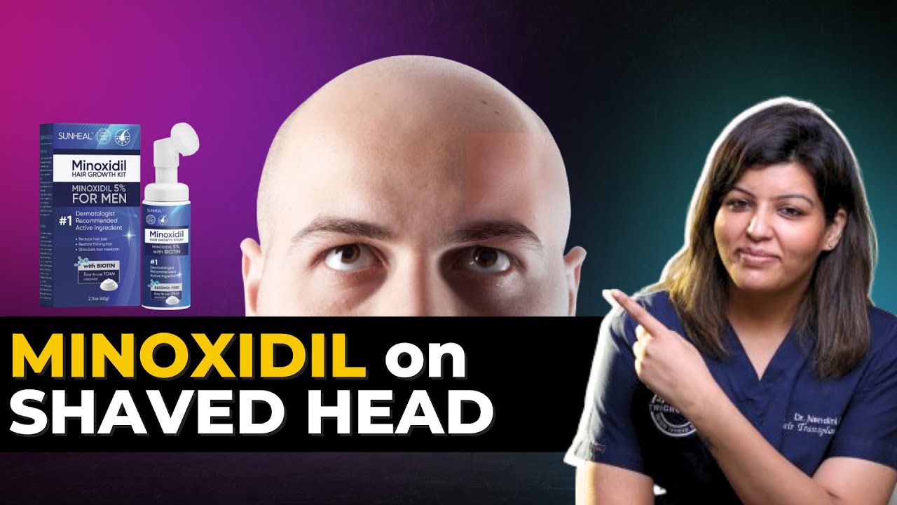 Minoxidil on a Shaved Head - Does it Work? | Dr. Nandini Dadu (BIG ...