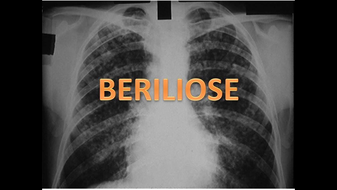 BERILIOSE - YouTube