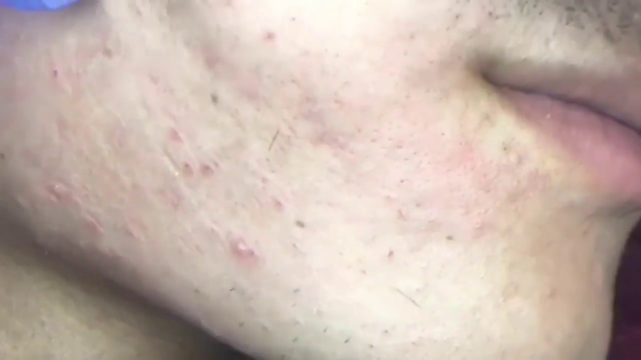 Many tiny blackheads removal #2 - YouTube
