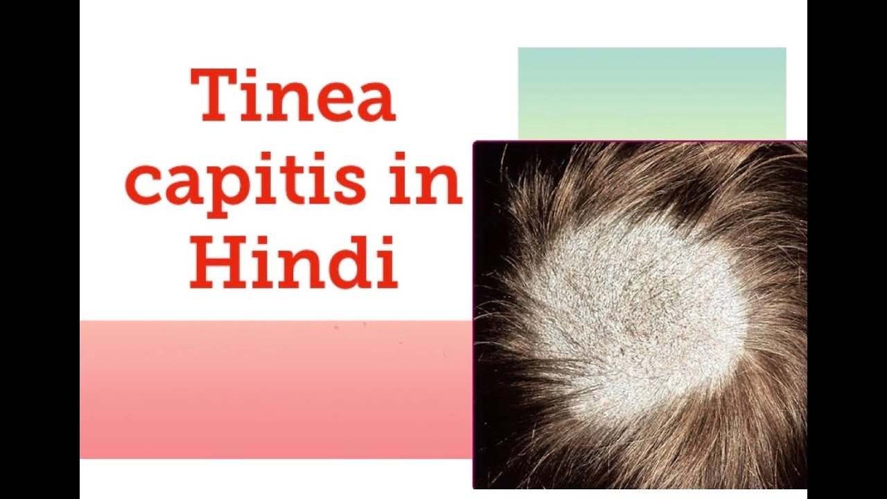 Tinea capitis in Hindi / Black dot , grey patch , kerion and favus In ...