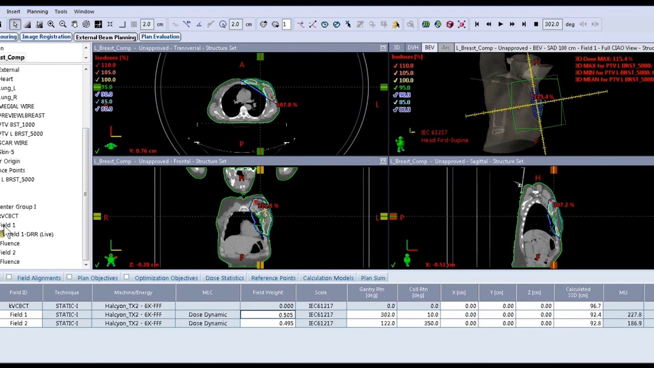 Halcyon Treatment Planning - Breast Irregular Surface Compensator - YouTube