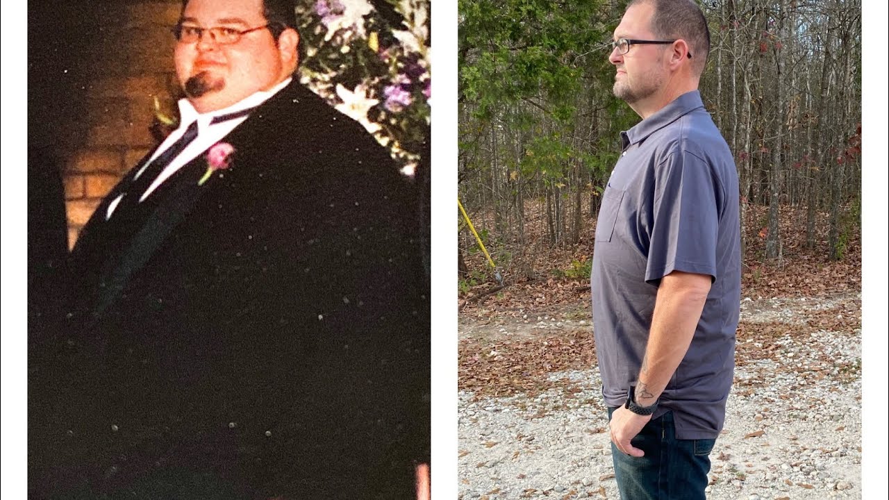 Excess Skin Removal Surgery Update. Panniculetomy. Caution Pic of skin ...