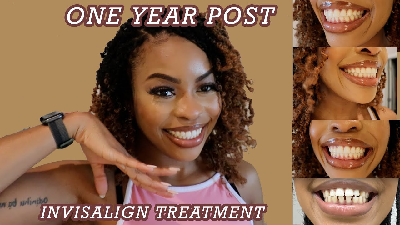 ONE YEAR POST INVISALIGN TREATMENT - YouTube