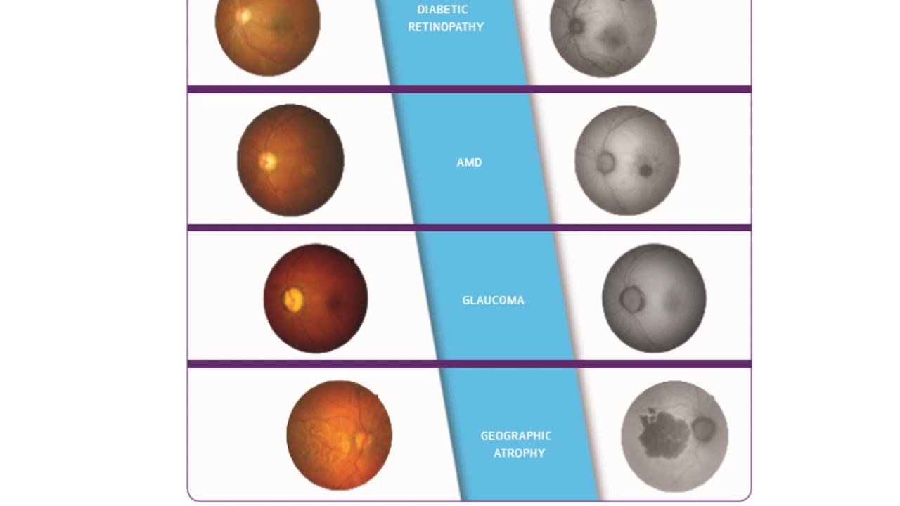 OPHTHA PRODUCTS - YouTube