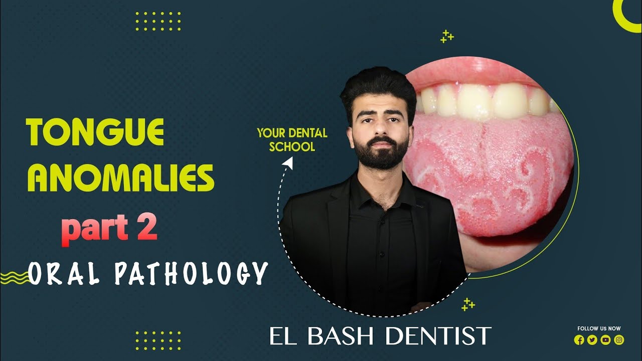 developmental anomalies || tongue anomalies 2 || oral pathology _ عزت ...