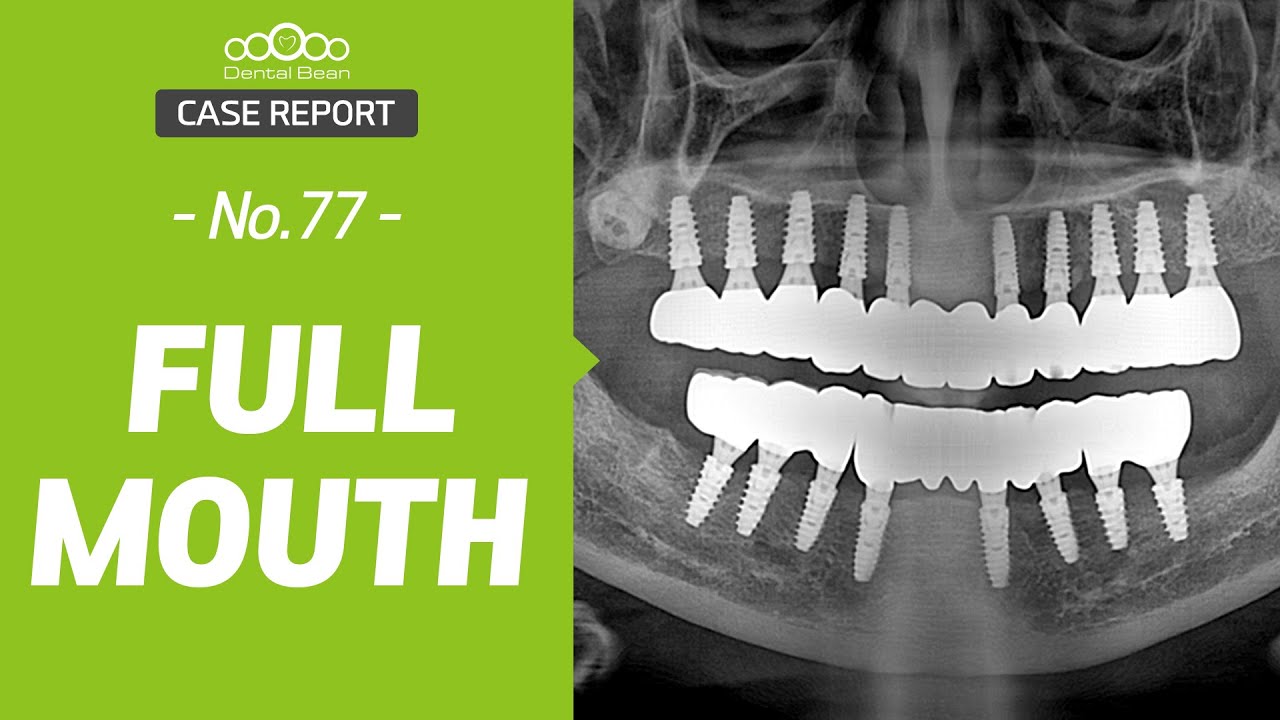 [MULTI_SUB] Immediate post-extraction implantation and Immediate ...