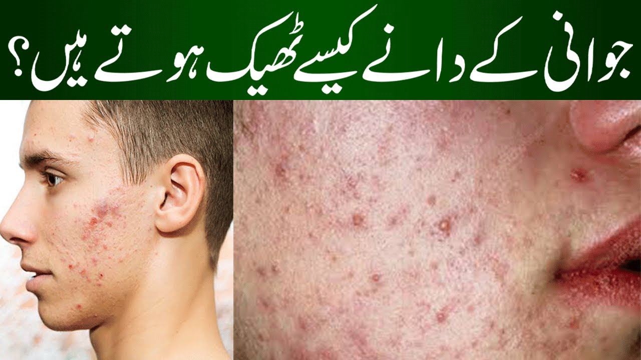 How is acne treated? | Prof Dr Ghazala Batt | Health Special | - YouTube