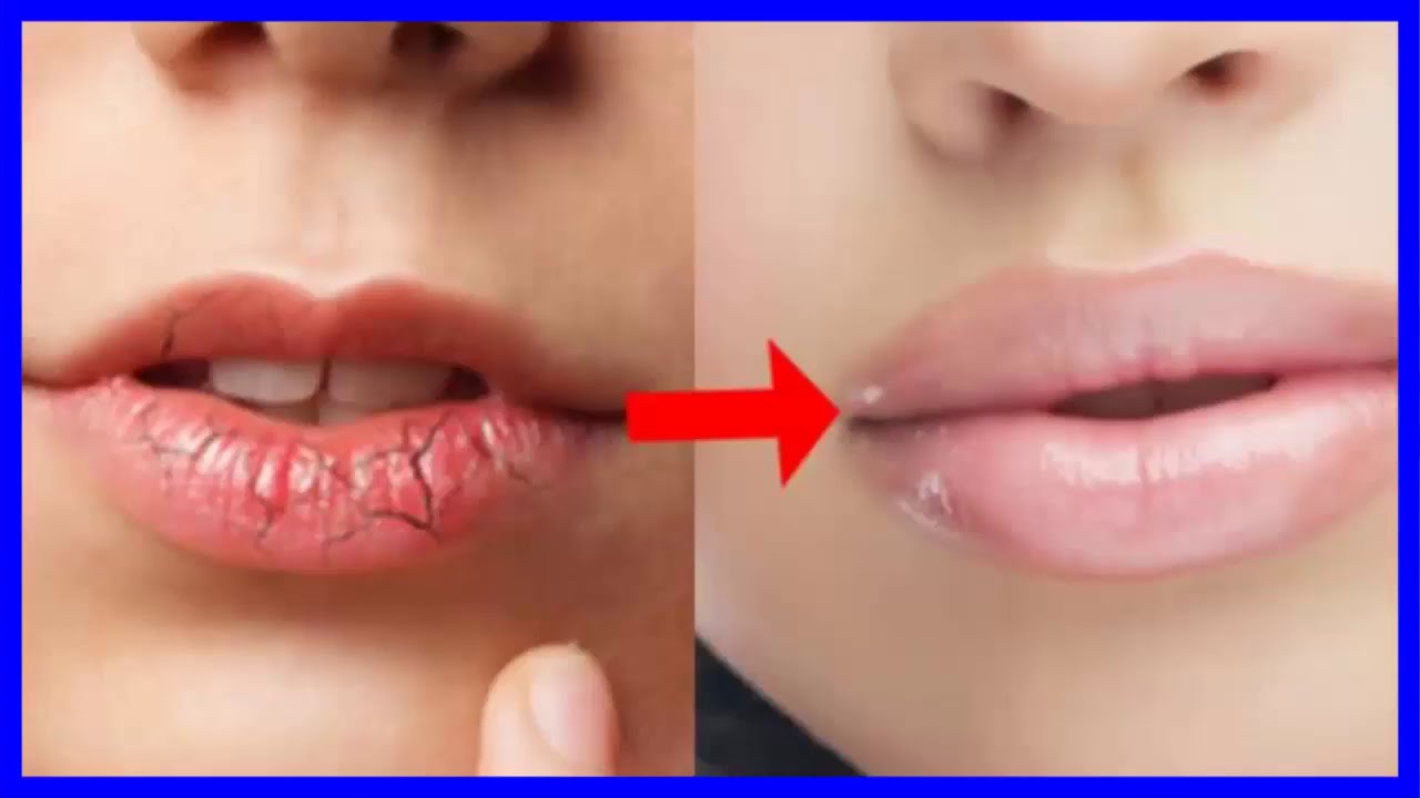 Cómo evitar y tratar la resequedad en los labios - YouTube