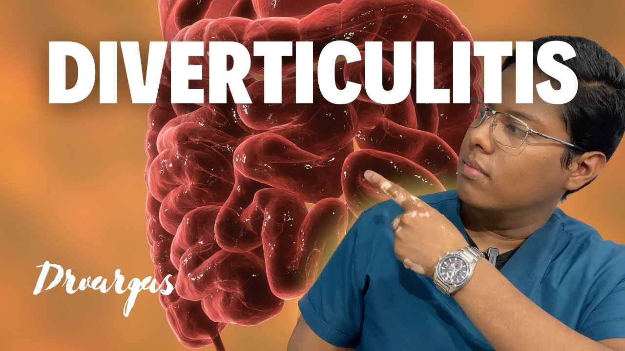 Dolor en lado izquierdo abdomen ¿Apendicitis o diverticulitis? | Síntomas Diverticulitis - YouTube