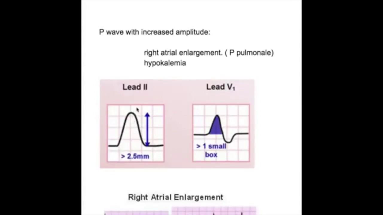 P Pulmonale P Mitrale P Wave Abnormalities Atrial Enlargement YouTube P Pulmonale P Mitrale P Wave Abnormalities Atrial Enlargement YouTube