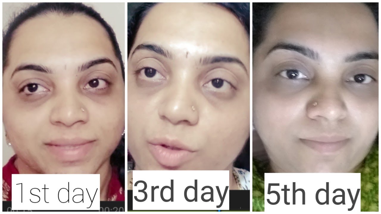 Chemical peel off skin treatment,my first sitting experience - YouTube